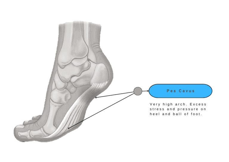 Foot Pain - Pes Cavus