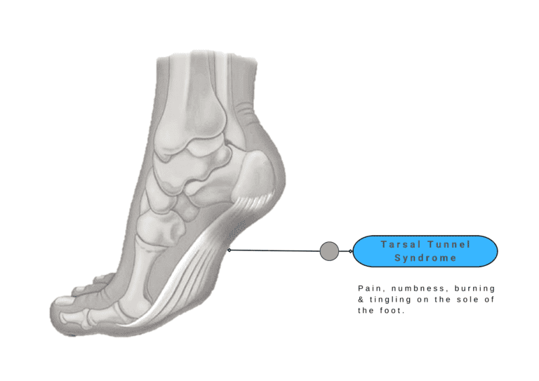 Foot Pain - Tarsal Tunnel Syndrome | Happiest Feet